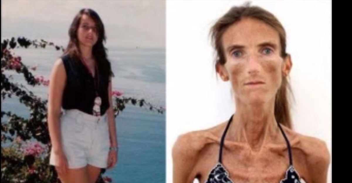 Ella Es Uno De Los Casos De Anorexia Más Graves Que Se Conozcan Y Verla ...