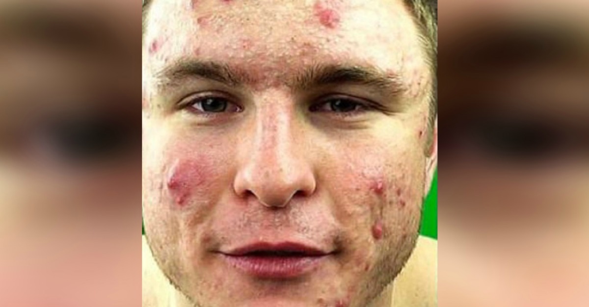 Este Chico Luchó Contra Un Severo Acné Por Años ¡Hasta Que Se Hizo ...